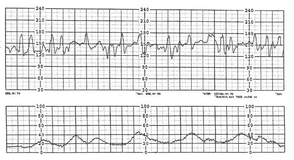 Fetal Heart Rate Monitoring Strip